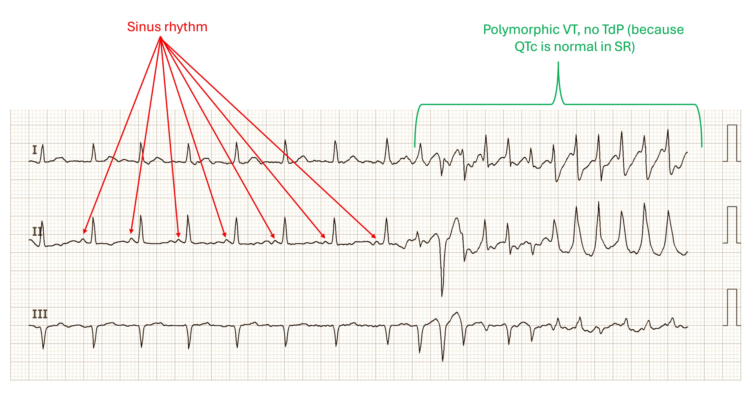 POLYMORPHIC VT | ECG Guru - Instructor Resources
